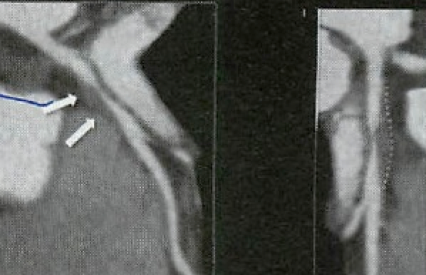 心臓CT(冠動脈CT)の画像診断のポイントは？冠動脈の解剖、番号は？