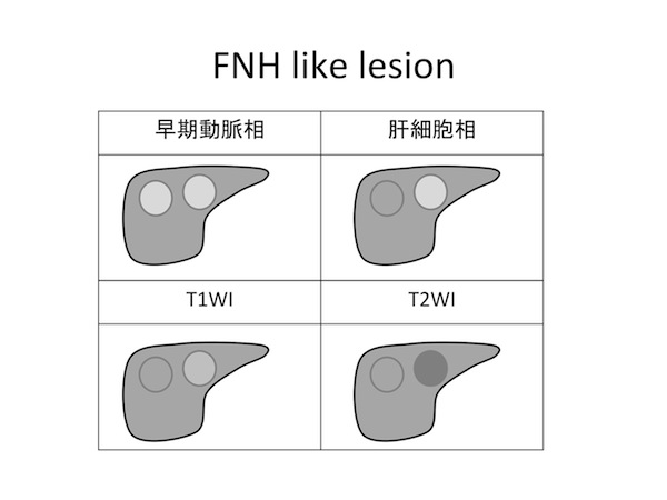 限局性結節性過形成(FNH)の画像診断 | 遠隔画像診断UP TO DATE