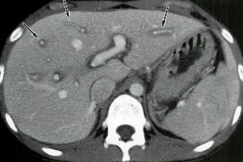 periportal collar(halo) signの鑑別診断(画像診断、画像所見) | 遠隔画像診断UP TO DATE
