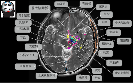 脳MRIの正常解剖図譜(横断像) | 遠隔画像診断UP TO DATE