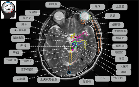 脳MRIの正常解剖図譜(横断像) | 遠隔画像診断UP TO DATE