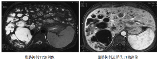 胆管内乳頭状腫瘍の画像診断(intraductal papillary neoplasm of the bile duct：IPNB)