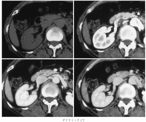 前立腺の解剖は？MRI画像の読み方のポイントは？